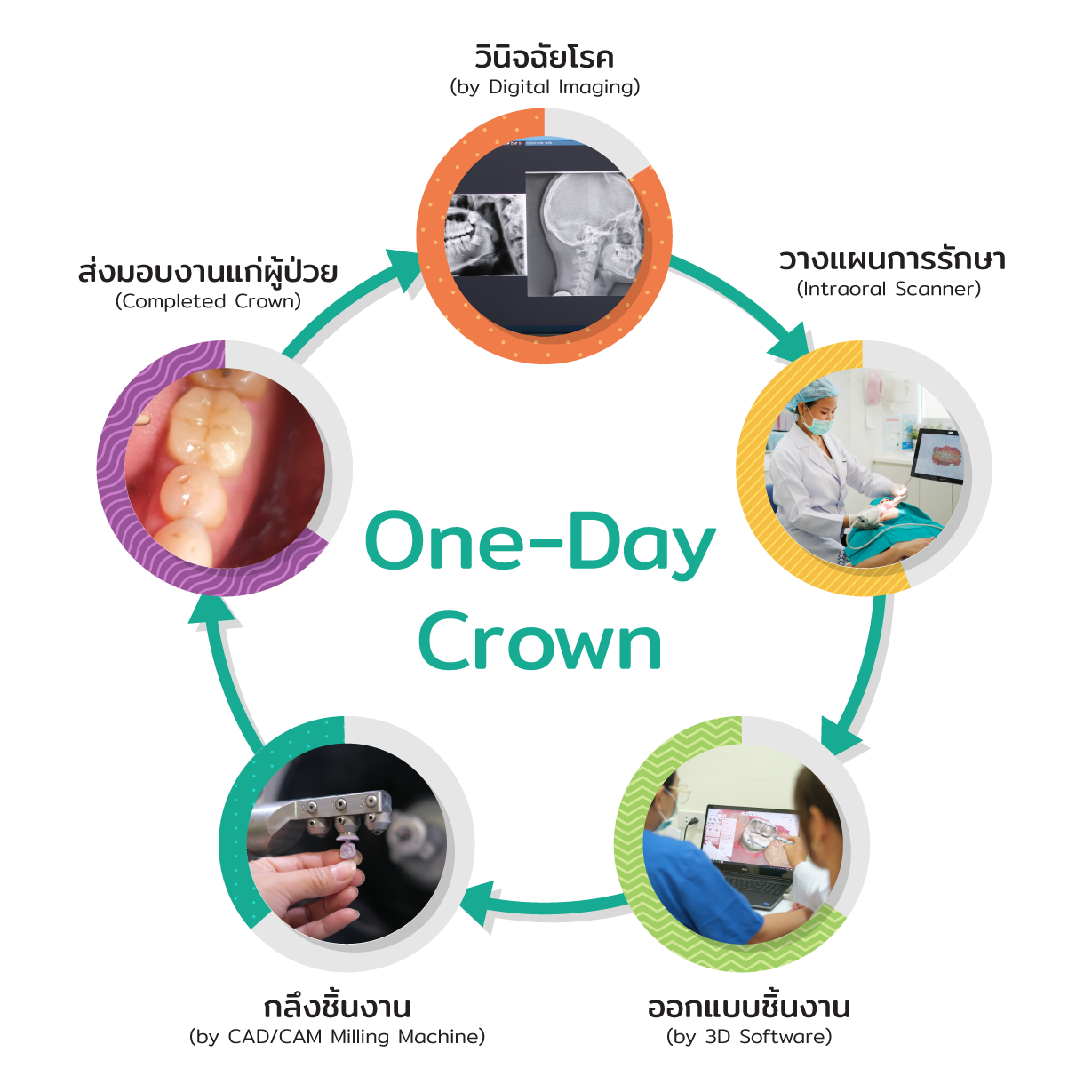 ครอบฟันวันเดียว One-Day Crown - article | โรงพยาบาลสมิติเวชศรีราชา